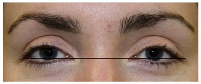 Eye Anomalies as Diagnostic Indicators of Communication Disorders ...