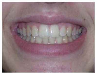 Orofacial Myofunctional Disorders: The Basics for SLPs - Article 1425