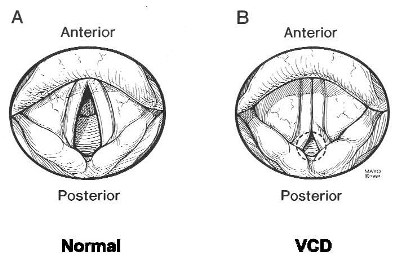 Using Spirometry to Diagnose and Treat Vocal Cord Dysfunction - Article ...