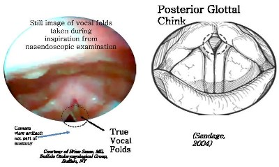 Using Spirometry to Diagnose and Treat Vocal Cord Dysfunction - Article ...